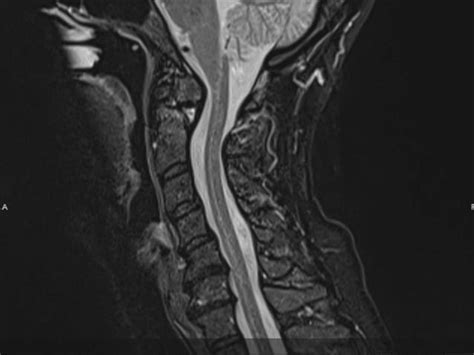 Odontoid Fractures In The Elderly Ppt
