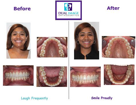 Teeth Before And After Braces Crowding Teeth Before And After Braces Crowding