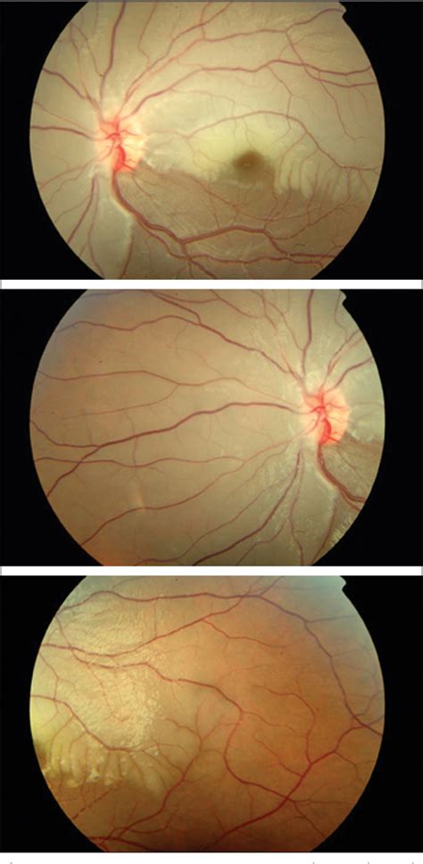 Figure 1 From Idiopathic Pediatric Retinal Artery Occlusion Semantic Scholar