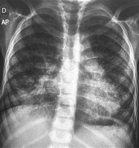 Anteroposterior Chest X Ray Showing A Bilateral Reticulonodular Anteroposterior Chest X Ray Showing A Bilateral Reticulonodular
