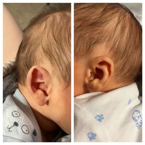 My Newborn Son Has Completely Different Shaped Ears R Mildlyinteresting