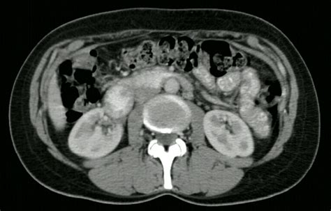 Superior Mesenteric Artery Syndrome Eurorad
