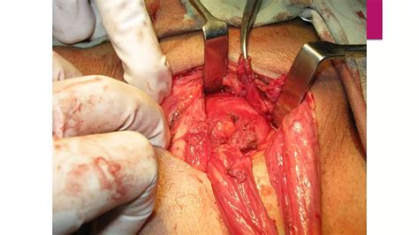 Hernia Operation Ppt