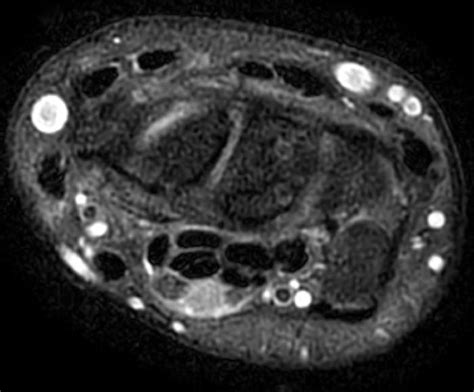 Persistent Median Artery Radsource