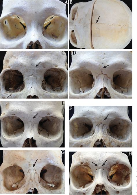 Figure 1 From Sex Determination From Metopic Suture And Supraorbital