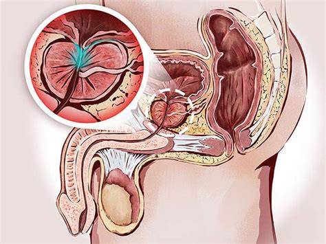 پروستاتیت مزمن یا التهاب پروستات چیست؟