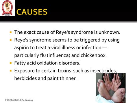 Reyes Syndromepptx