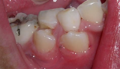 Faq What If There Are Two Teeth Growing In One Spot — Discovery