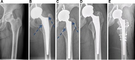 Risk Factors For Periprosthetic Femoral Fractures After Cementless