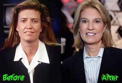 Greta Van Susteren Plastic Surgery Off The Record