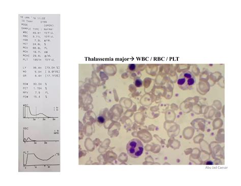 Rbc Histogram Pdf