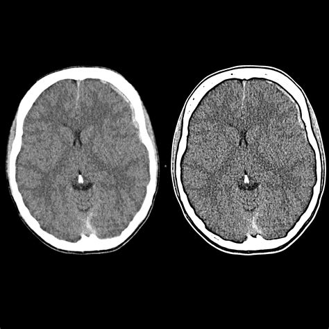 Pediatric Subdural Hematoma Pediatric Radiology Reference Article Pediatric Imaging