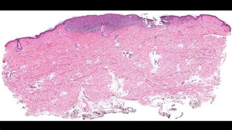 Punishing Conditions Drive Cancer Metastasis Technology Networks