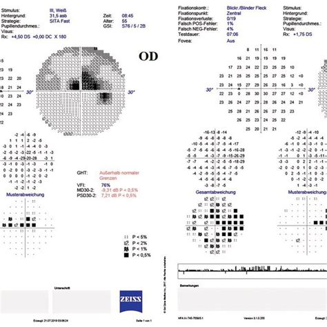 Visual Field Of Both Eyes In The Right Eye Od A Paracentral Scotoma Download Scientific