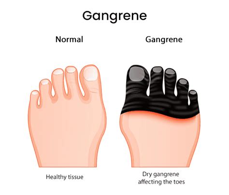 7 Effective Methods For Gangrene Treatment Without Surgery
