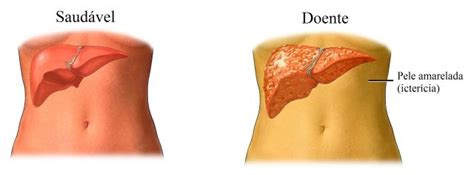 Icterícia Neonatal Você Sabe O Que é Mamãe And Cia