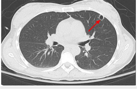 Non Contrast Ct Chest Showing A Left Cavitary Lesion Red Arrow On The Download Scientific