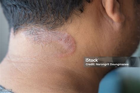 어두운 피부를 가진 아시아 남성은 수분을 유발하는 곰팡이로 인해 두피 피부염으로 고통받습니다 곰팡이 가려움증 피부 질환 알레르기 건선 습진 피부염 아토피성 습진에 대한 스톡