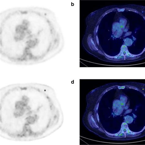 Incidentally Detected Tiny 18 F Fdg Avid Breast Nodule In A