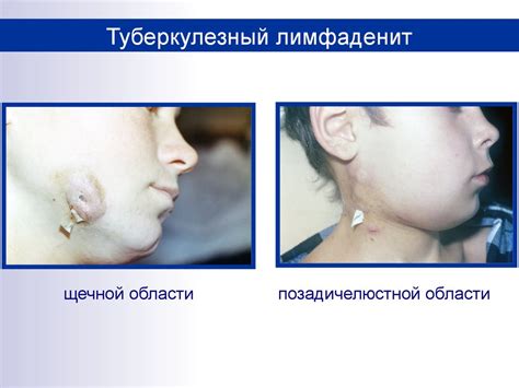 Воспалительные заболевания челюстно лицевой области у детей Особенности их лечения Лимфадениты