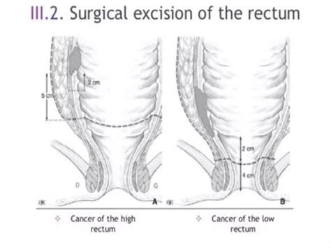 Transanal Total Mesorectal Excision Pptx