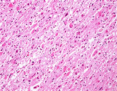 Diffuse Astrocytoma Light Micrograph Stock Image C Science Photo Library