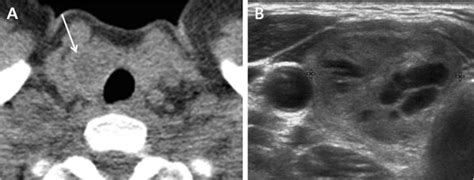 A 49 Year Old Woman With An Adenomatous Goiter A Low Dose Helical Ct