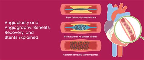 A Deep Dive Into Angioplasty Angiography And Life After