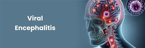 Understanding Viral Encephalitis Symptoms And Treatment