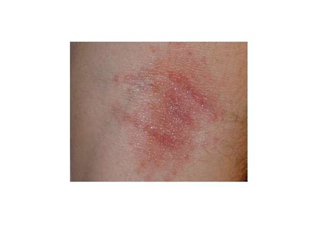 Asp Sting Signs And Treatment Health Advisor