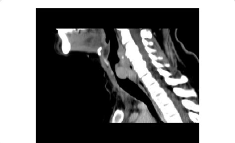Neck Ct Scan Sagittal View Showed Submucosal Subglottic Mass Narrowing