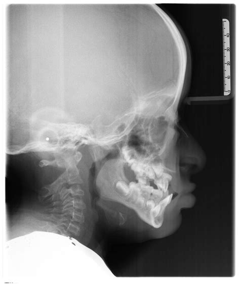 Osteogenesis Imperfecta Type 2