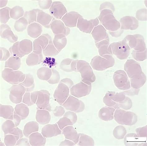Plasmodium Vivax Parasite Diagnosis
