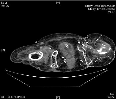 Figure 1 From Hourglass Urinary Bladder In A Male Patient With