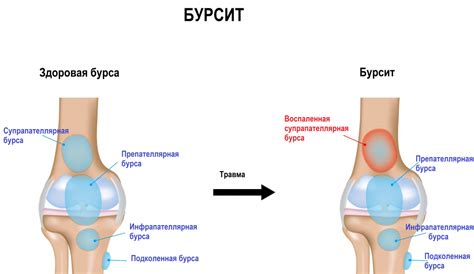 Бурсит коленного сустава: причины, симптомы и методы лечения