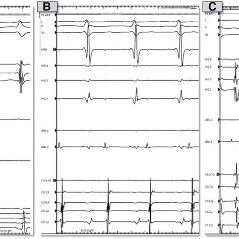 Representative Electrocardiograms And Intracardiac Electrograms From