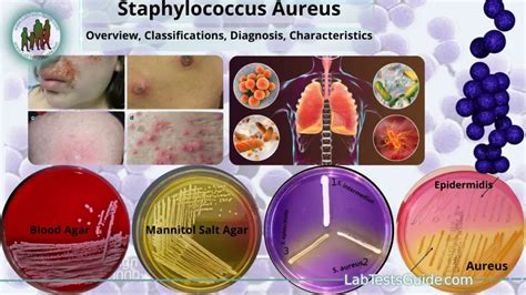 Staphylococcus Epidermidis Lab Tests Guide