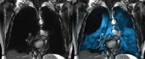 Xenon Gas Mri 3d Visualization Radiating Hope