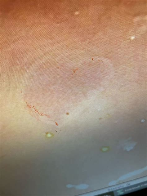 Veysel Tahan Md Facg Fasge Facp Fesbgh On Linkedin Rectal Polyp