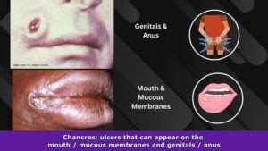 Syphilis Nursing Nclex Review Causes Stages Treatments