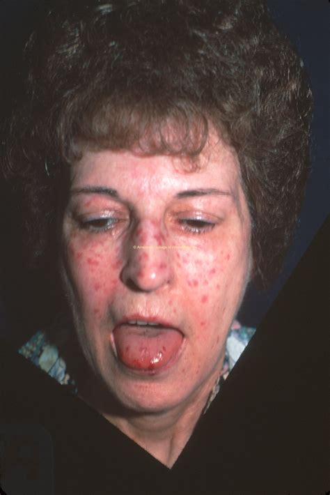 Systemic Sclerosis Rheumatology For Primary Care