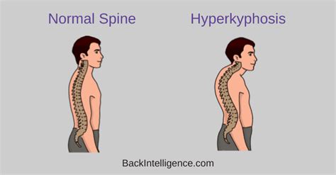How To Fix Dowagers Hump Causes Symptoms Exercises