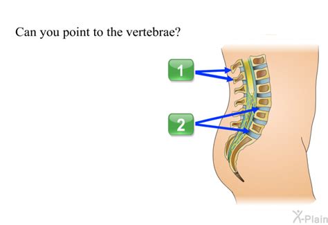 Lumbar Laminectomy And Possible Disk Excision Minimally