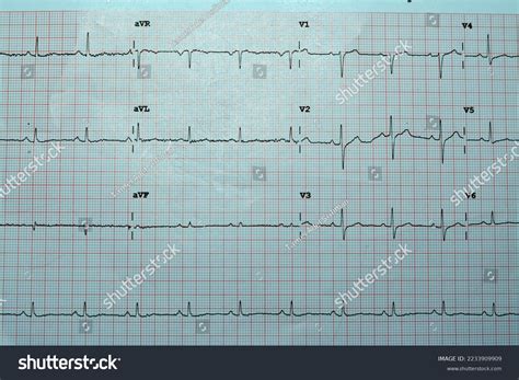 2 053 Normal Ecg Images Stock Photos Vectors Shutterstock