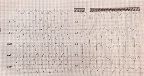 Electrocardiogram Showing Rbbb And Anterior Stemi Download Scientific Diagram