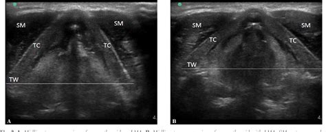 Figure 3 From Ultrasound Comparison Of External And Internal Neck