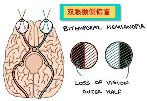 深圳大学第一附属医院黄国栋教授：垂体微课堂 认识垂体瘤 脑医汇