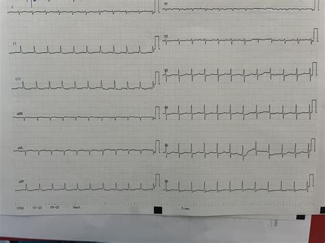 87f Sob Afib Aflutter Pat R Ekgs
