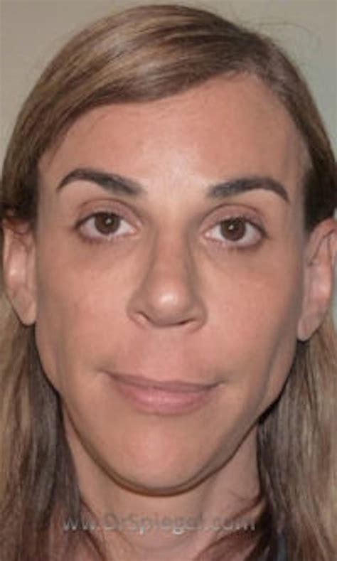 Patient 155005224 Non Surgical Feminization Before And After Photos