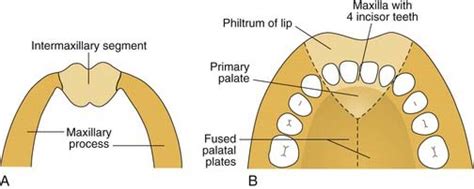 Cleft Lip And Palate Ento Key